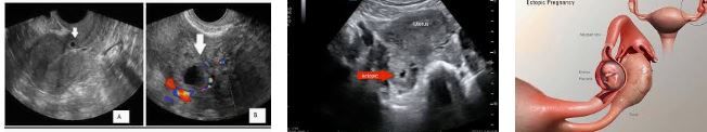 Laparoscopy Vs Laparotomy In Treatment Of Ectopic Pregnancies