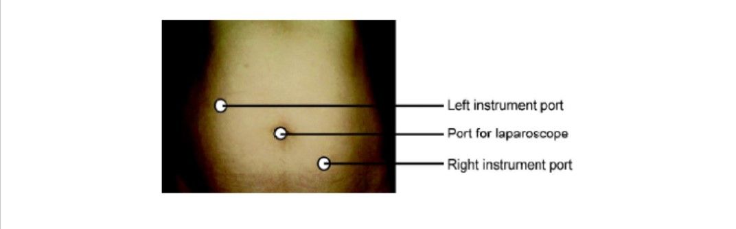 Laparoscopic Ovarian Surgery