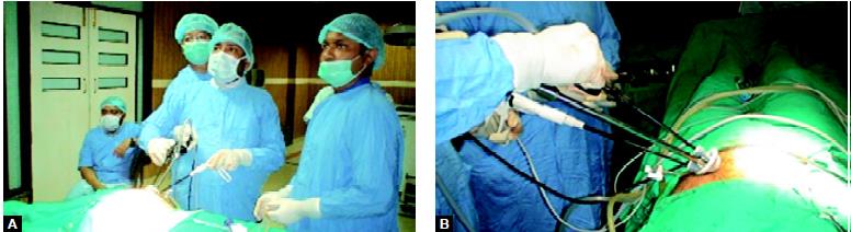 Single Incision Laparoscopic Surgery