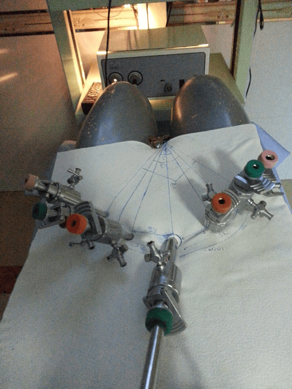 Ideal port positioning in different laparoscopic urological procedures