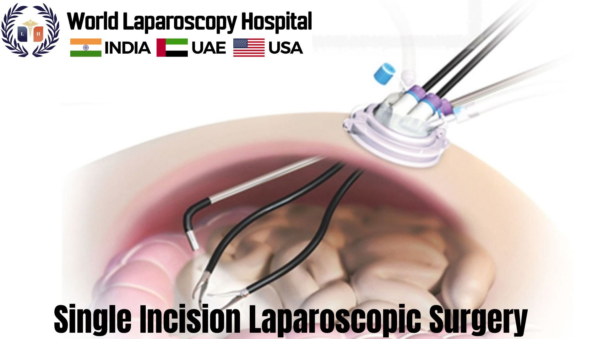 Single Incision Laparoscopic Surgery - Dr. R.K. Mishra