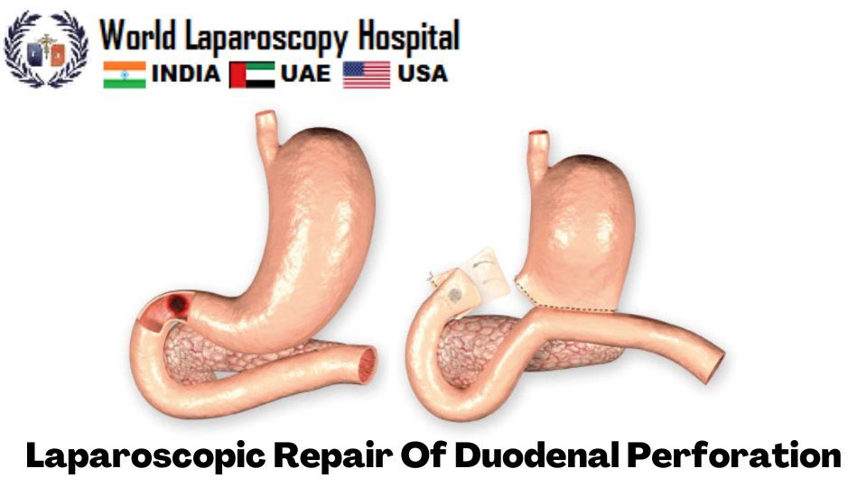 Perforated Duodenal Ulcer Surgery