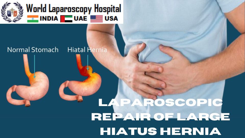 Hiatal Hernia Repair Laparoscopic